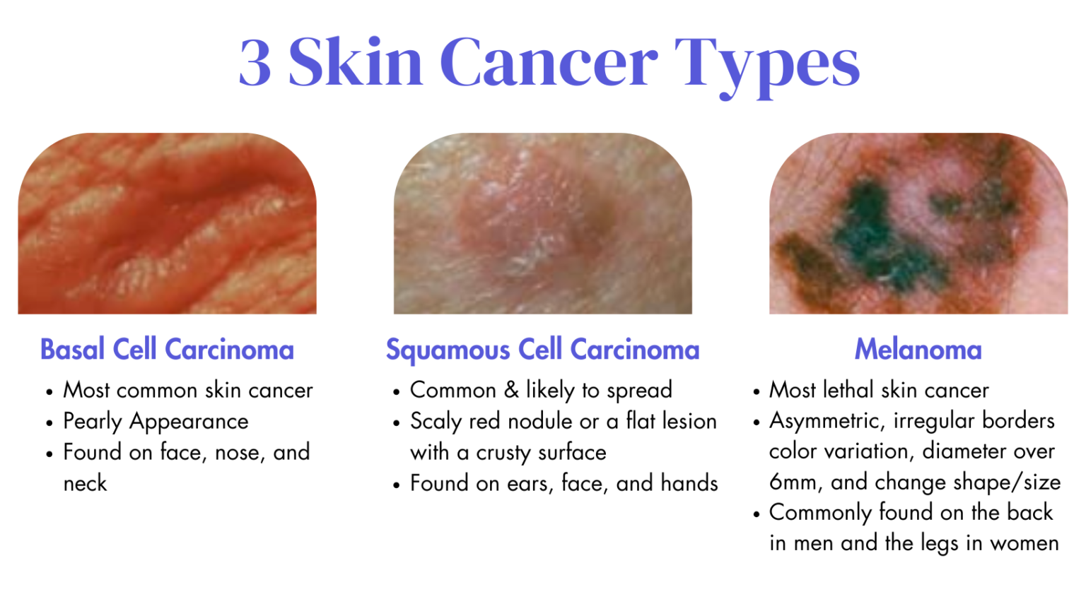 Types of Skin Cancer | DermOnDemand