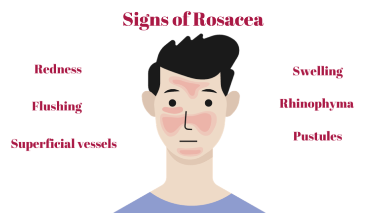 Rosacea Causes and Treatments | DermOnDemand