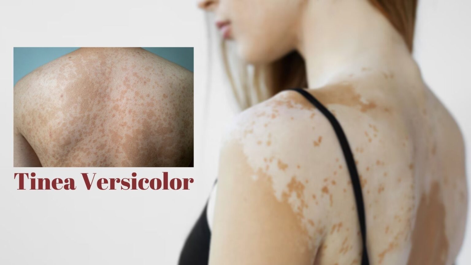 Tinea Versicolor: A Frequently Encountered Fungal Skin Condition ...
