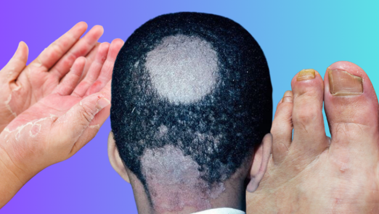 Treating Fungal Infections | DermOnDemand