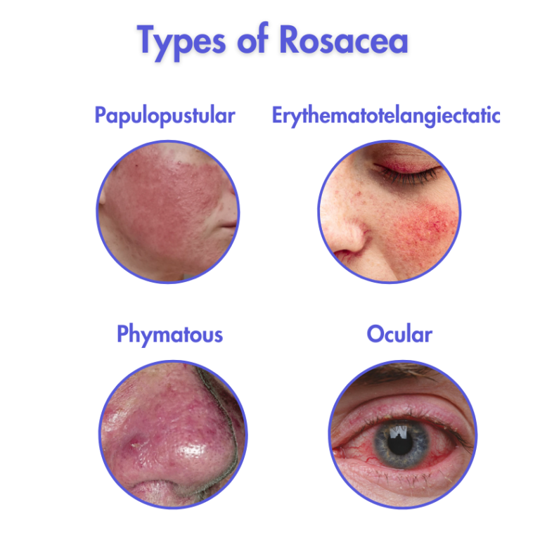 Rosacea Causes and Treatments | DermOnDemand