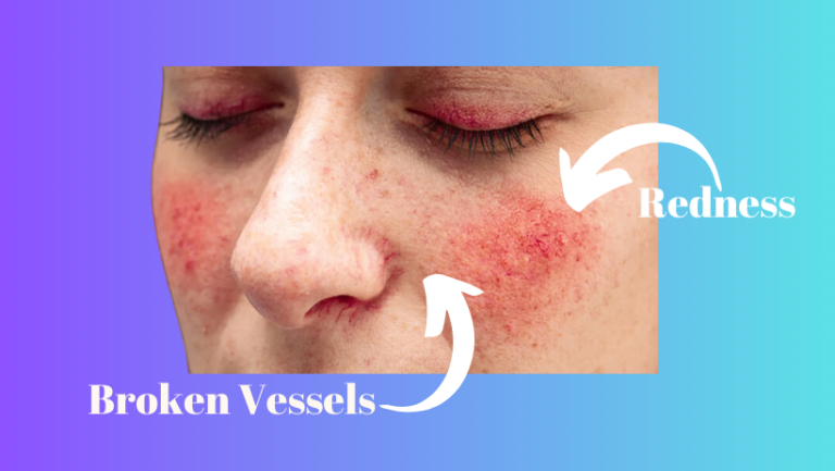 Rosacea Causes and Treatments | DermOnDemand