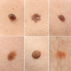 Intradermal Nevus: Understanding the Common Skin Growth
