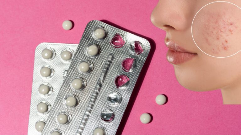 Is Your Birth Control Pill Giving You Acne?