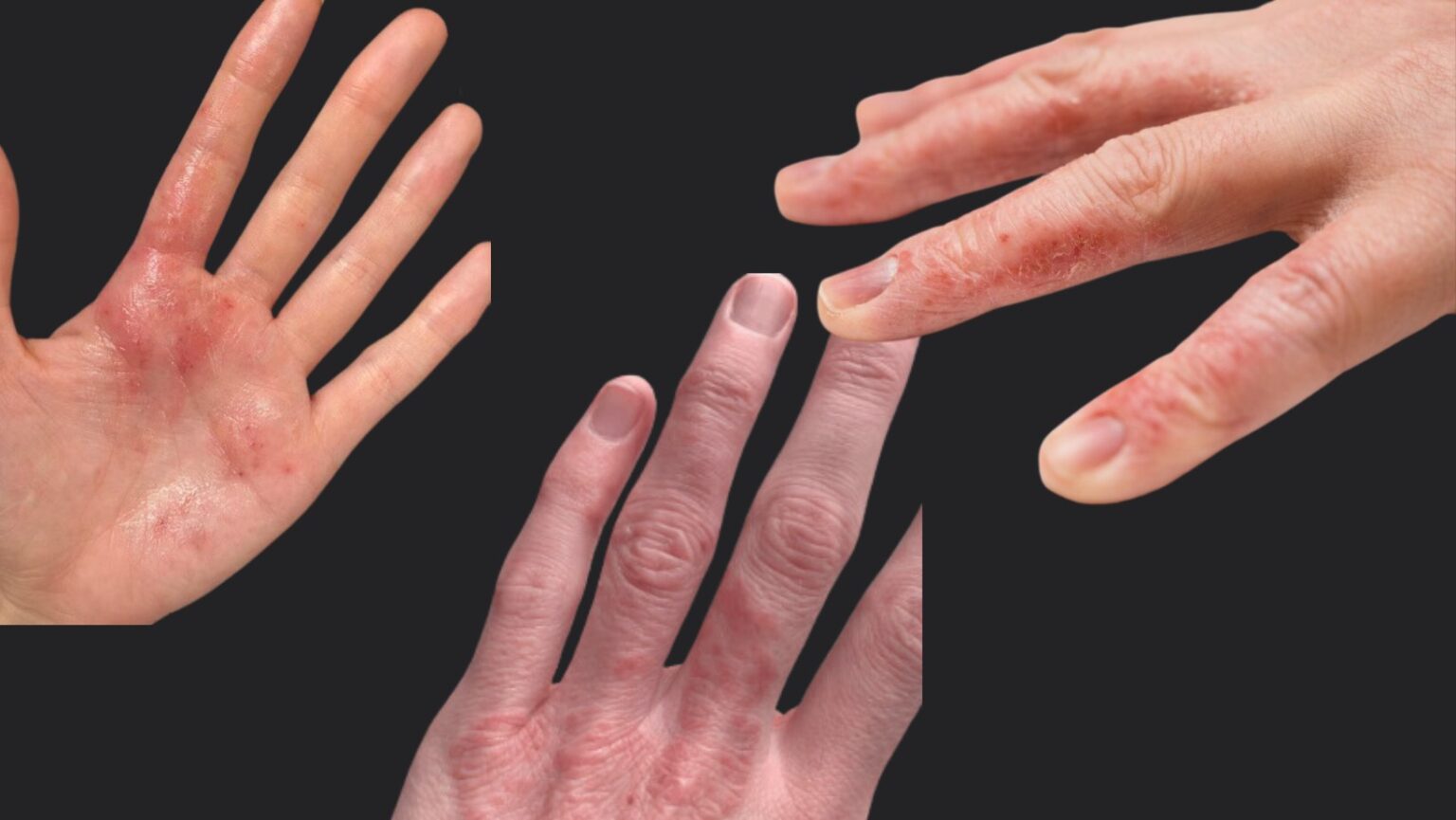 Understanding Dyshidrotic Eczema | DermOnDemand