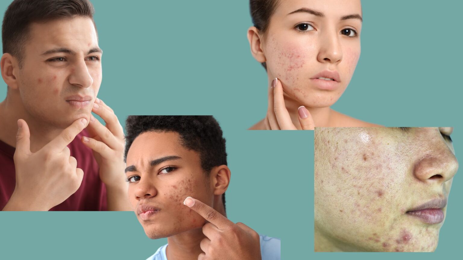 Acne Clear Skin | DermOnDemand