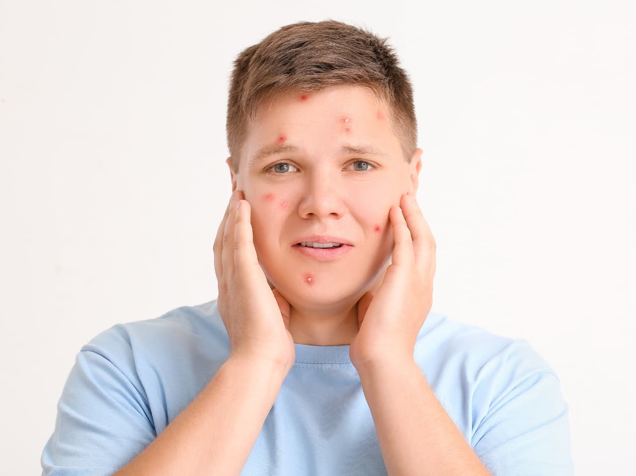 Is a Second Round of Accutane the Right Choice for You? - DermOnDemand